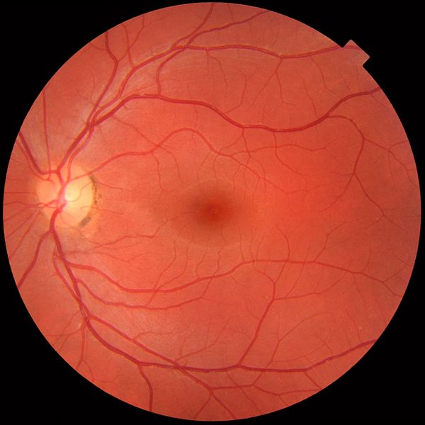 Is The Funduscopic Exam Worthwhile For The General Practitioner 